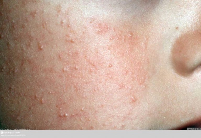 Winter is coming: A dermatologist’s tips for managing keratosis pilaris ...