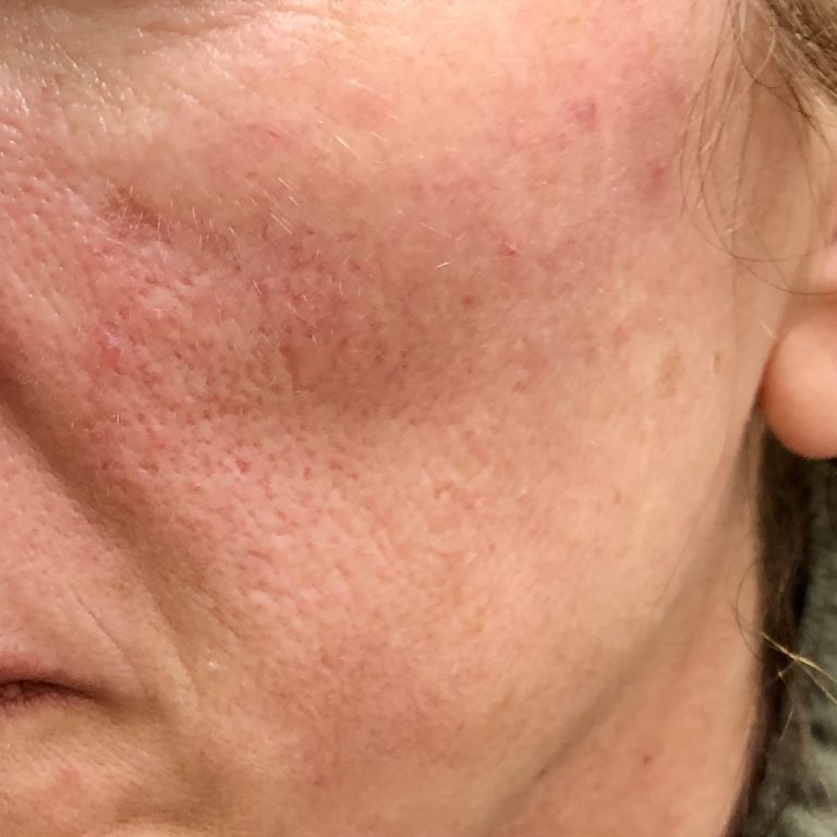 Red cheeks with many “broken capillaries” – what can you do? - SkinCare ...