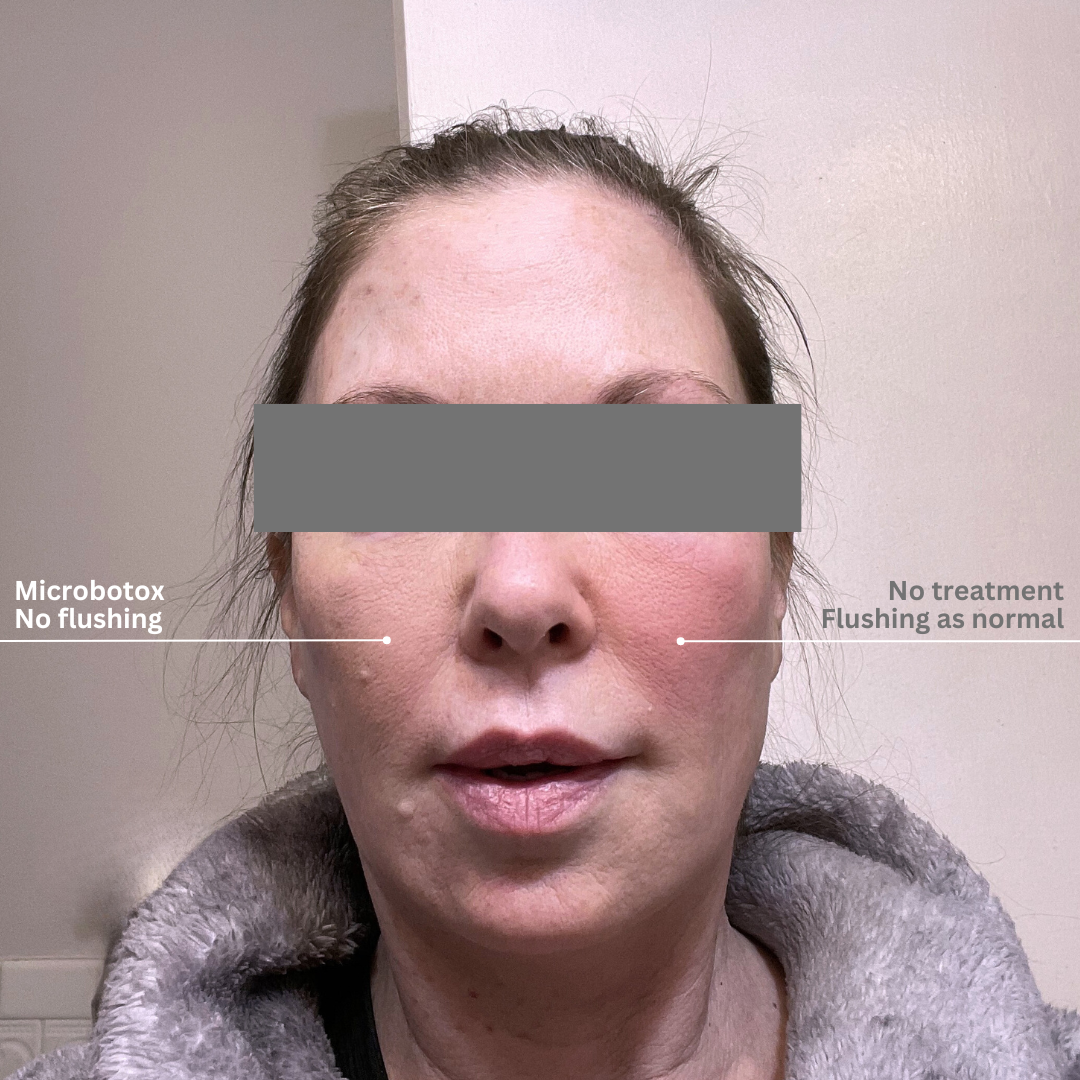 Microbotox: The secret to ‘glass skin’? - SkinCare Physicians